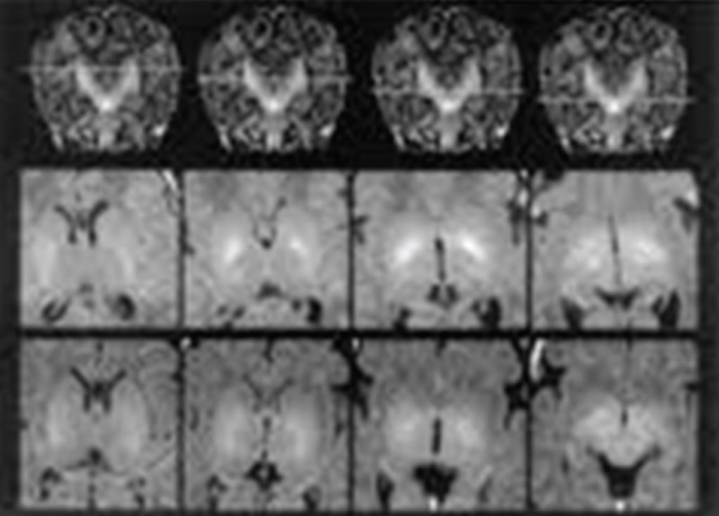 Bilirubin encephalopathy due to Rh incompatibility - einstein (São Paulo)