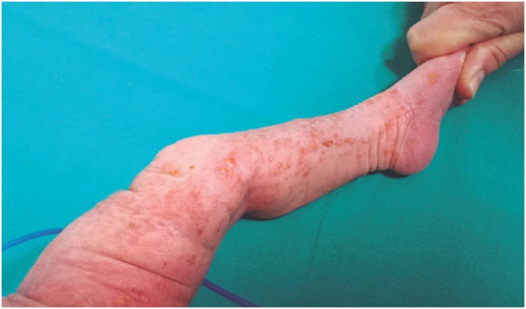 Vesicular lesions in a neonate: what's your diagnosis? - einstein (São ...