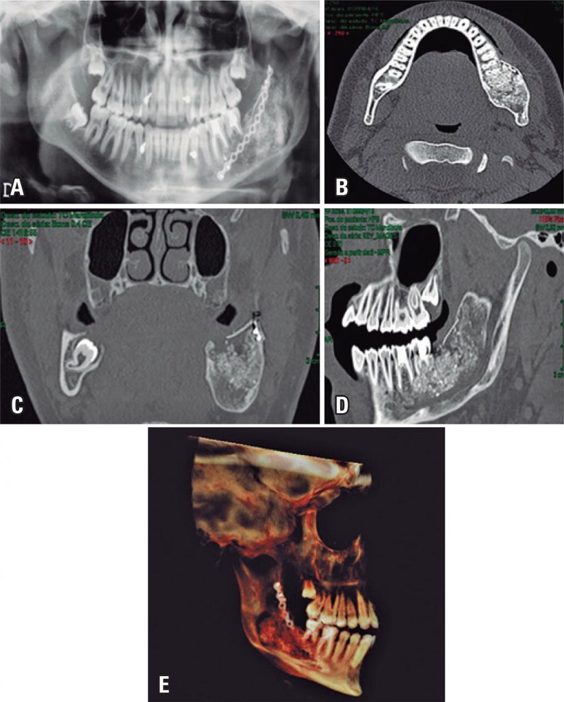 Off-label use of rhBMP-2 as bone regeneration strategies in mandibular ...