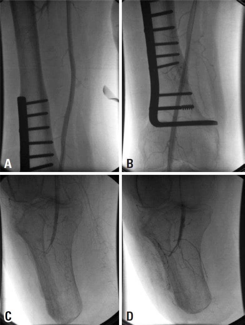 Fibrinólise intra-arterial para tratamento da isquemia aguda em coto de ...