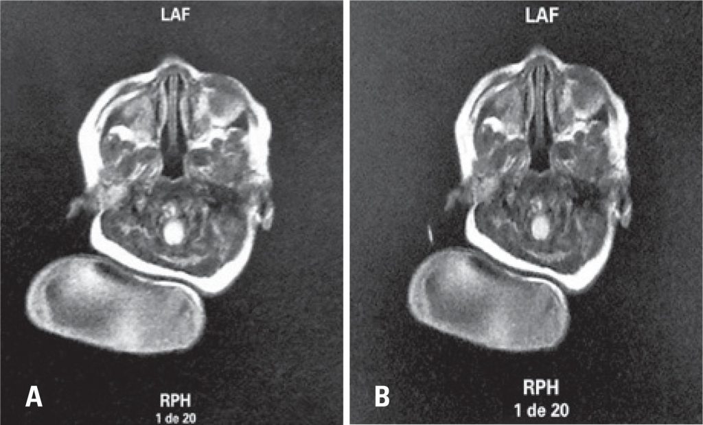 Congenital occipital myelocele - einstein (São Paulo)