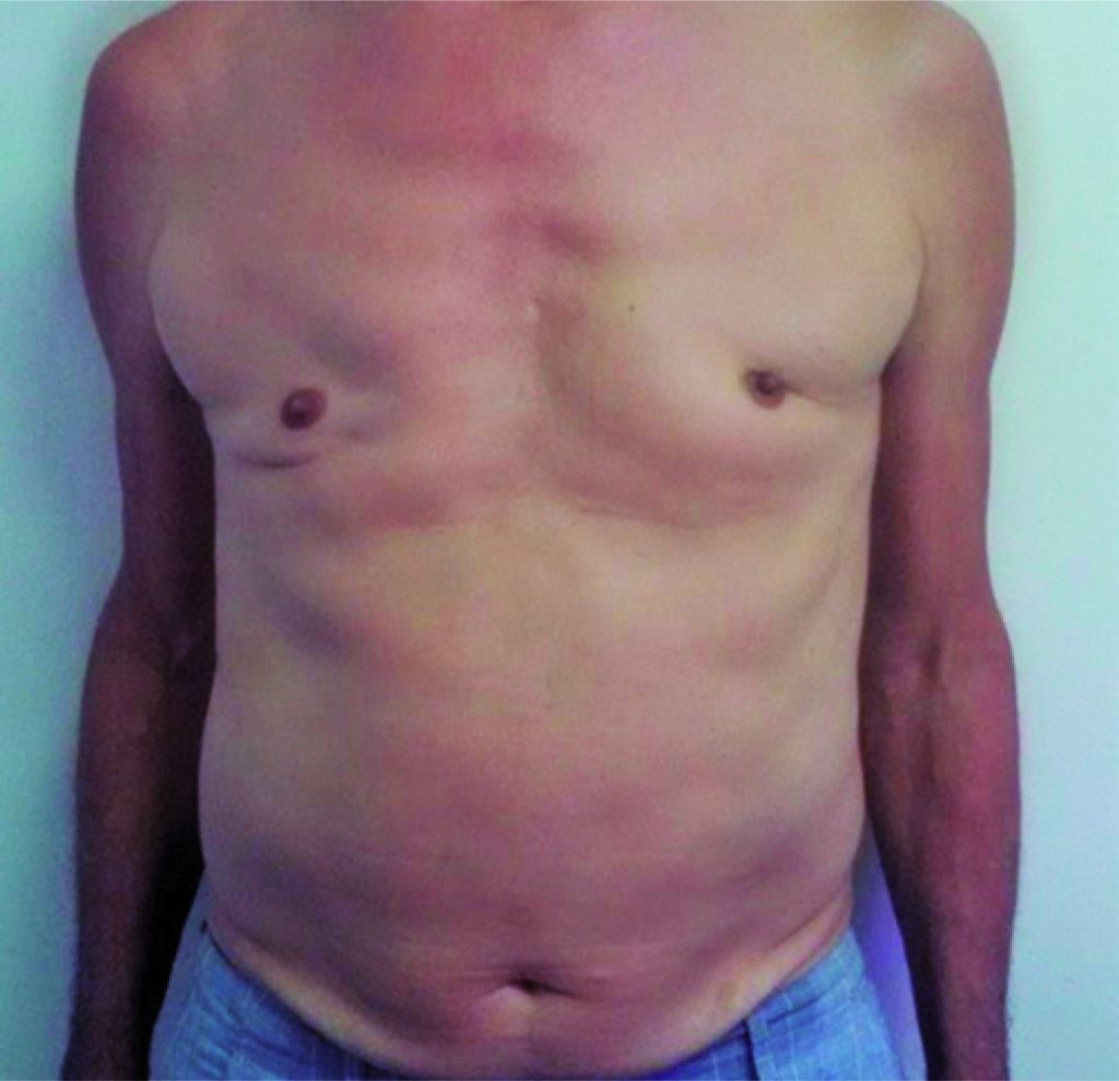 X-linked spinal and bulbar muscular atrophy (Kennedy’s disease): the ...