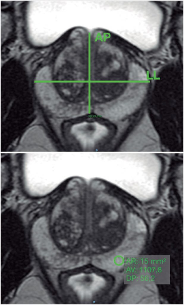 Comparative study between monoexponential and biexponential diffusion ...