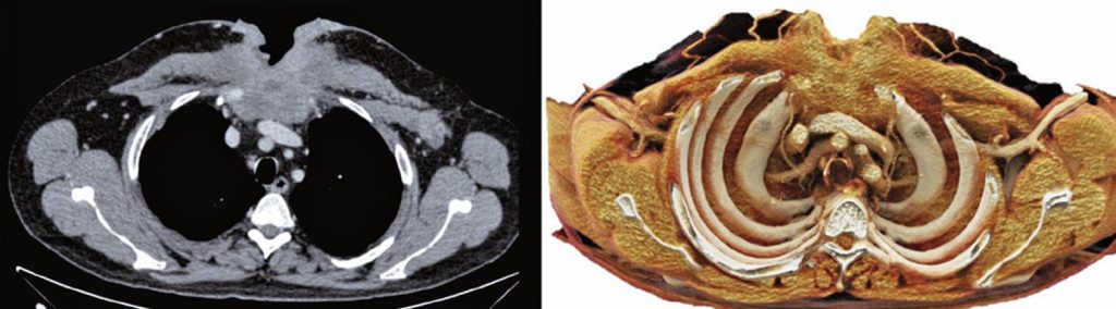 Cinematic rendering for three-dimensional reconstructions of the chest ...