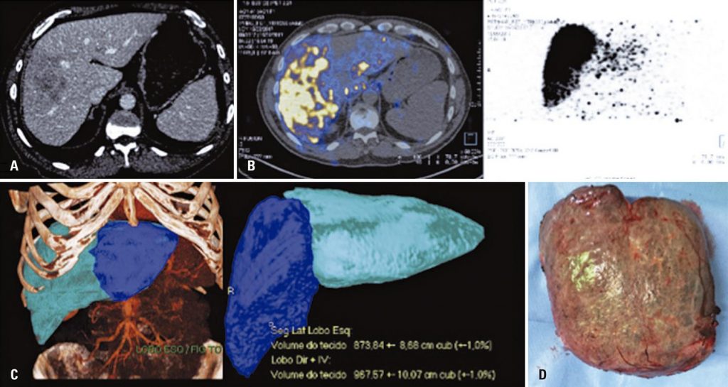 Transarterial radioembolization for liver tumors as neoadjuvant therapy ...