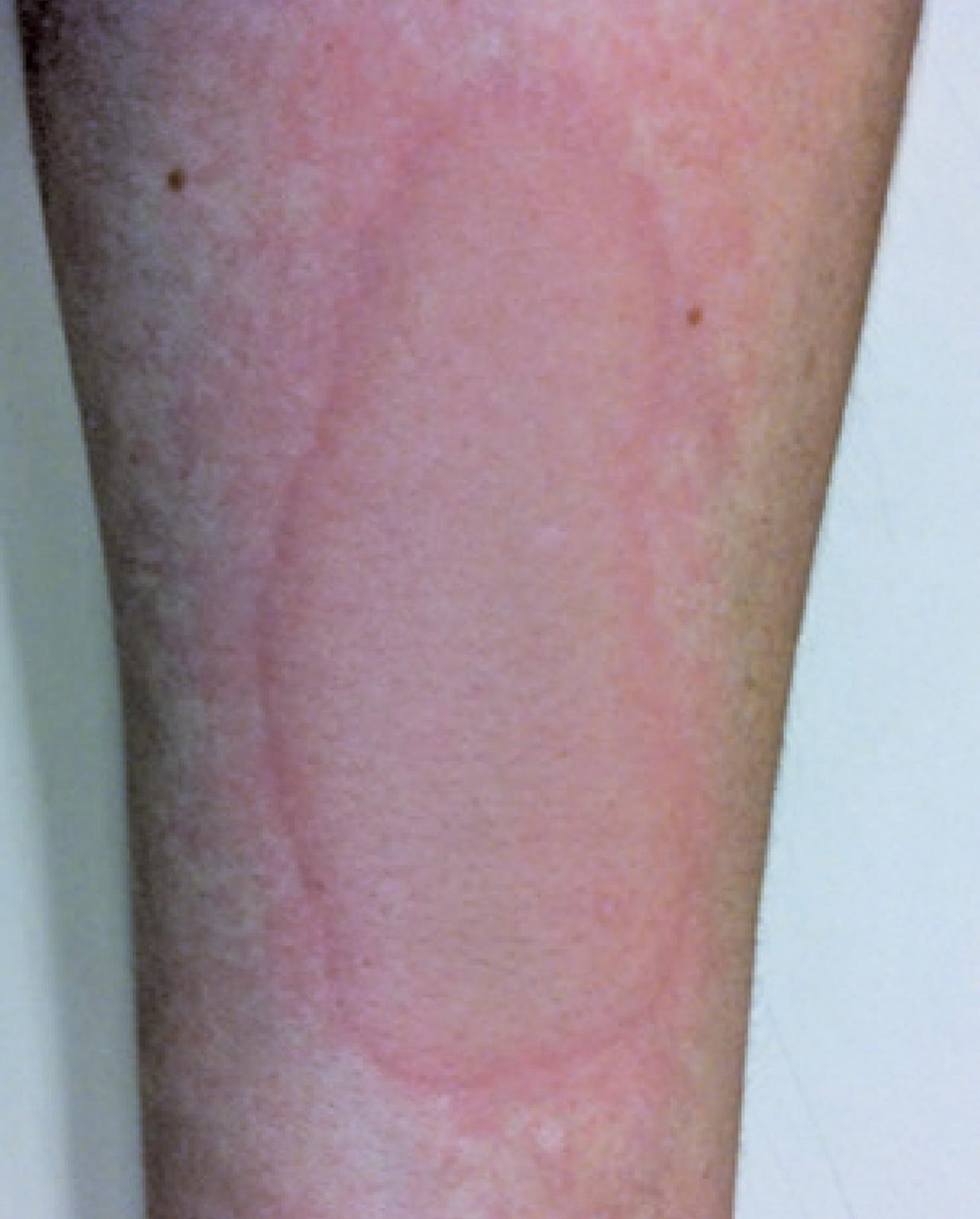 Chronic inducible urticaria: confirmation through challenge tests and ...