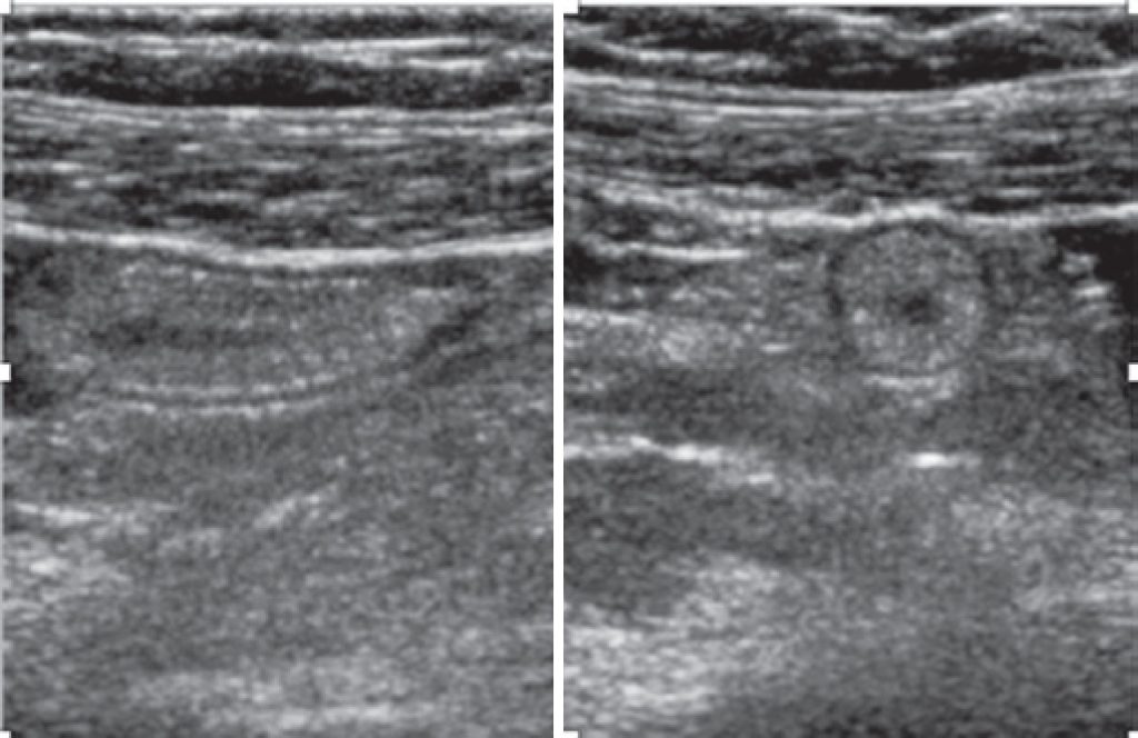 Caecal appendix lipomatosis in a pregnant patient mimicking acute ...
