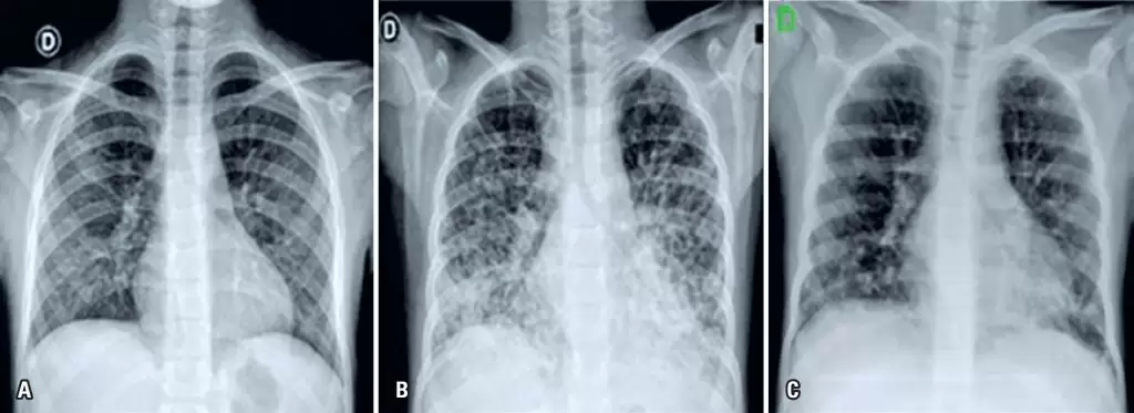 Lesão pulmonar aguda relacionada à transfusão associada com infusão de ...