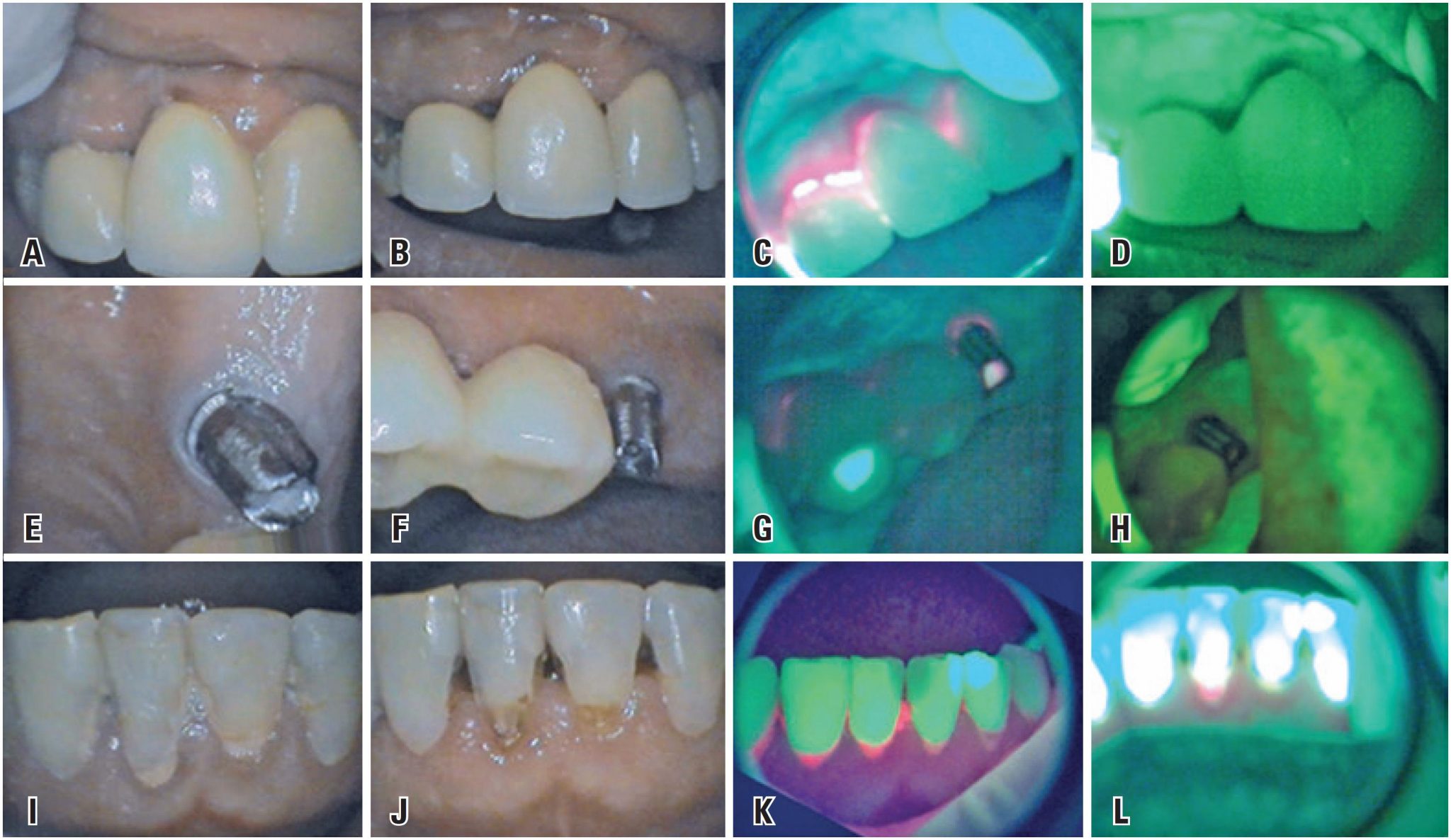 Use of wide-field optical fluorescence for visualization of oral ...