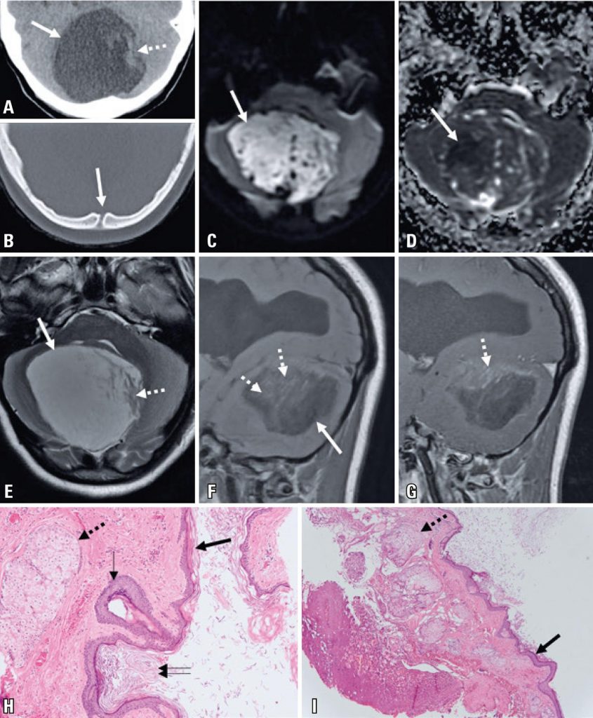 A T1-hypointense intracranial dermoid cyst - einstein (São Paulo)