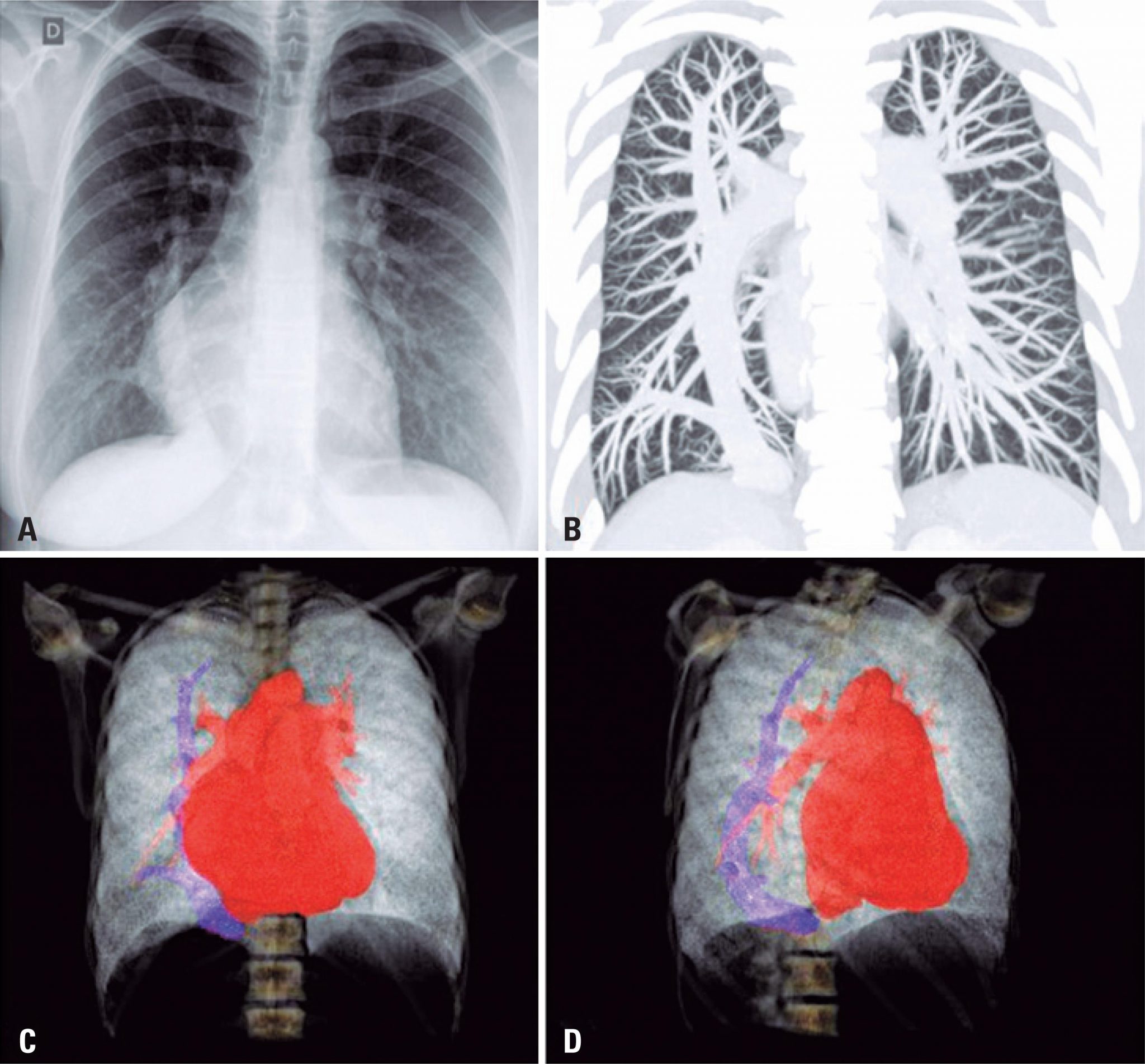 Scimitar syndrome: a rare disease - einstein (São Paulo)