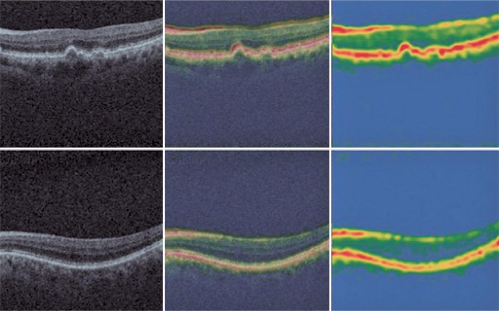 Machine learning in image analysis in ophthalmology - einstein (São Paulo)