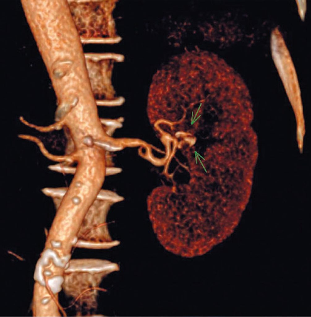 Calcified intrarenal aneurysm simulating urinary lithiasis - einstein ...