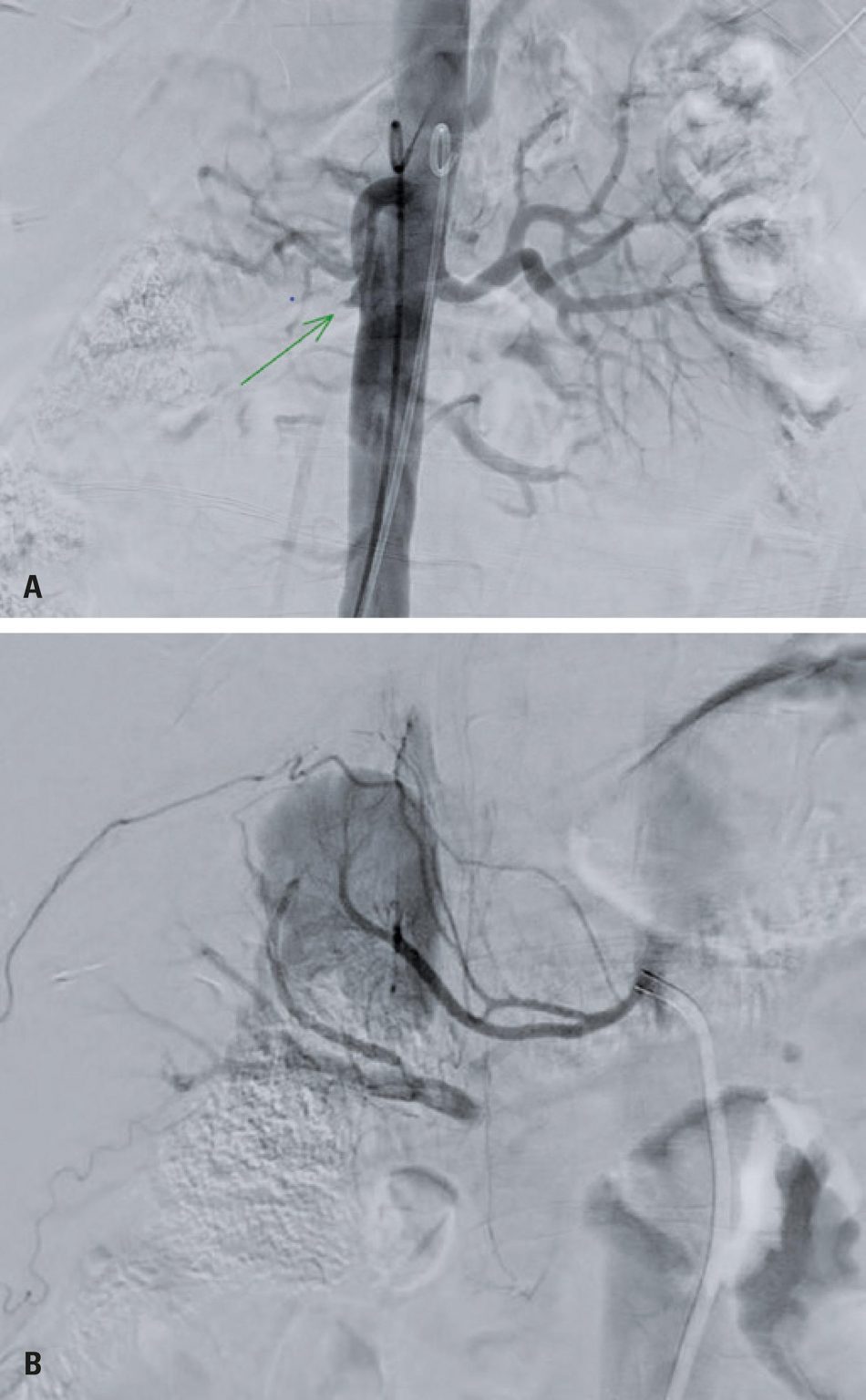 Spontaneous renal artery dissection: angioplasty with stent ...