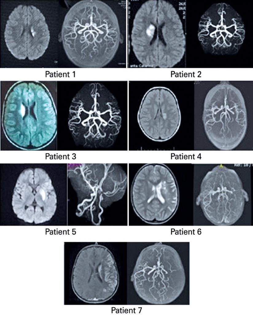 Post-varicella arterial ischemic stroke in children and neurocognitive ...