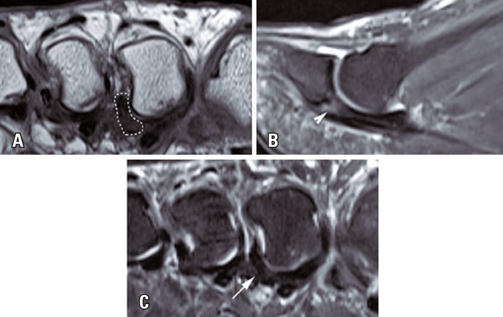 Degenerative injuries of the metatarsophalangeal plantar plate on ...