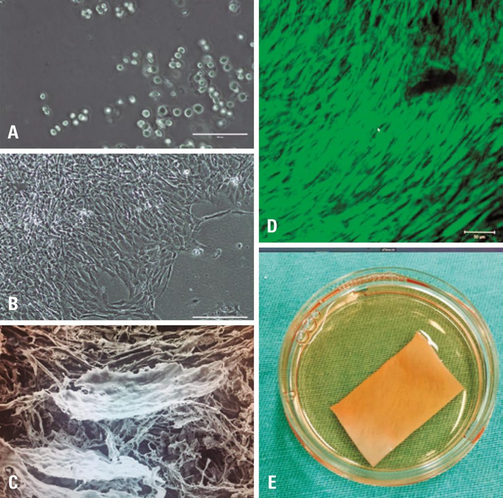 Matrix-assisted autologous chondrocyte transplantation for treatment of ...