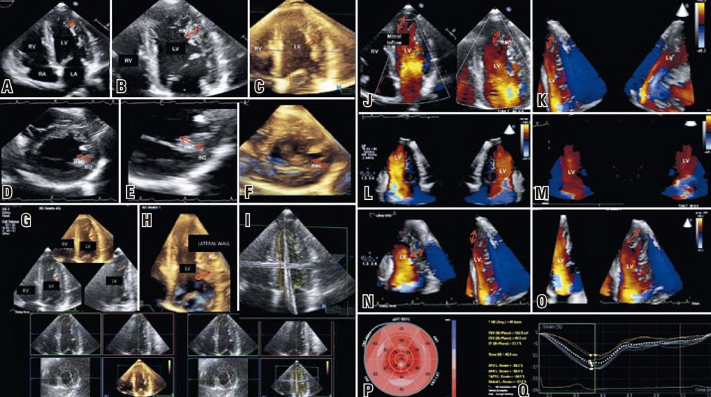 Left ventricular noncompaction highlighted by three-dimensional and ...