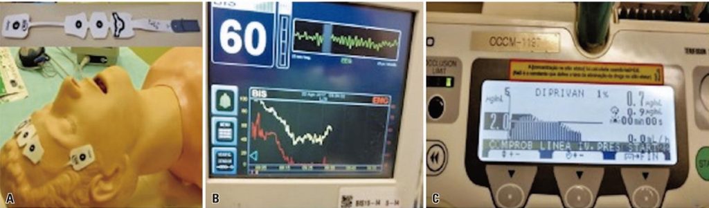 Sleep endoscopy as a complementary diagnostic method for snoring and ...