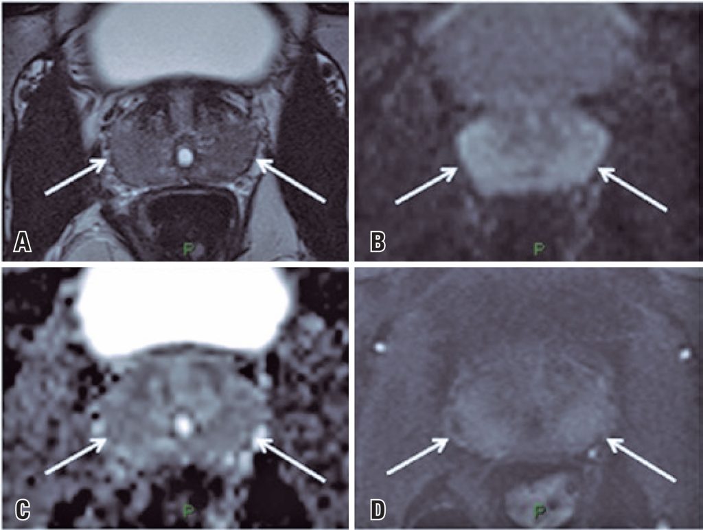 Prostate imaging features on magnetic resonance imaging of young ...