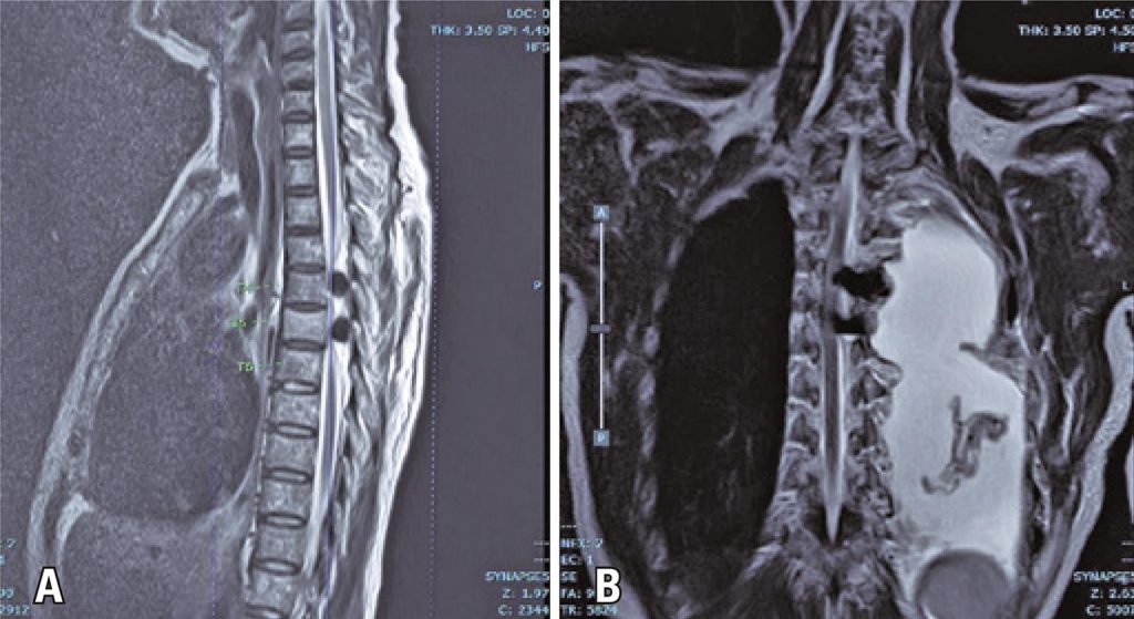 Post-thoracotomy paraplegia after oxidized cellulose spinal compression ...