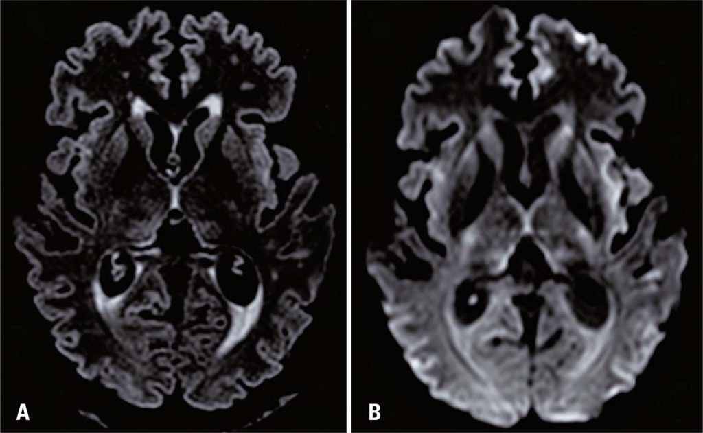 Cortical ribbon sign on neuroimaging in a patient with hepatic ...