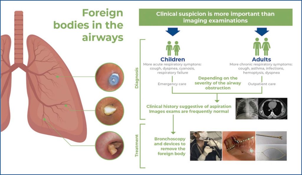 Analysis of 108 flexible bronchoscopies for the removal of foreign ...