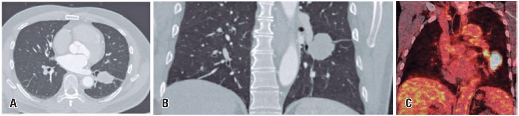 Sarcoid-like reaction induced by neoadjuvant immunotherapy in Stage III ...