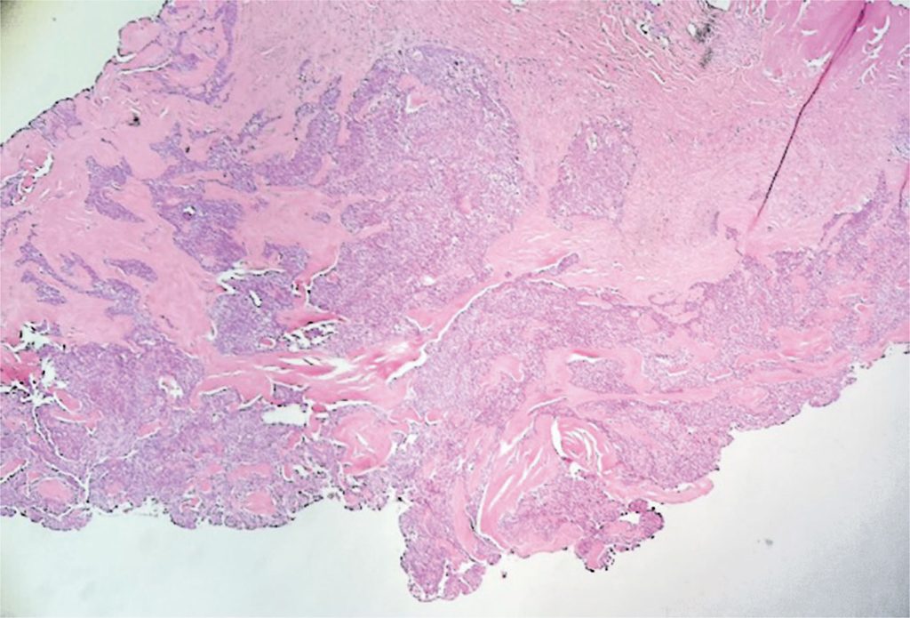 Nodular vulvar lesions and its key differential diagnoses: a case ...