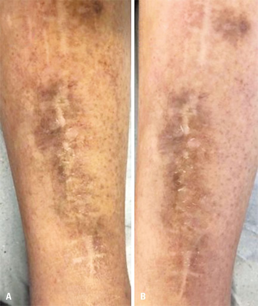 Cutaneous manifestations of diabetes mellitus: a narrative review ...