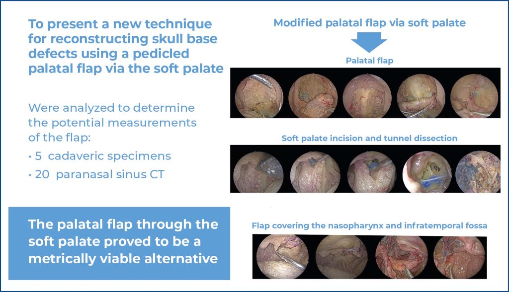 Modified palatal flap via soft palate for skull base reconstruction ...