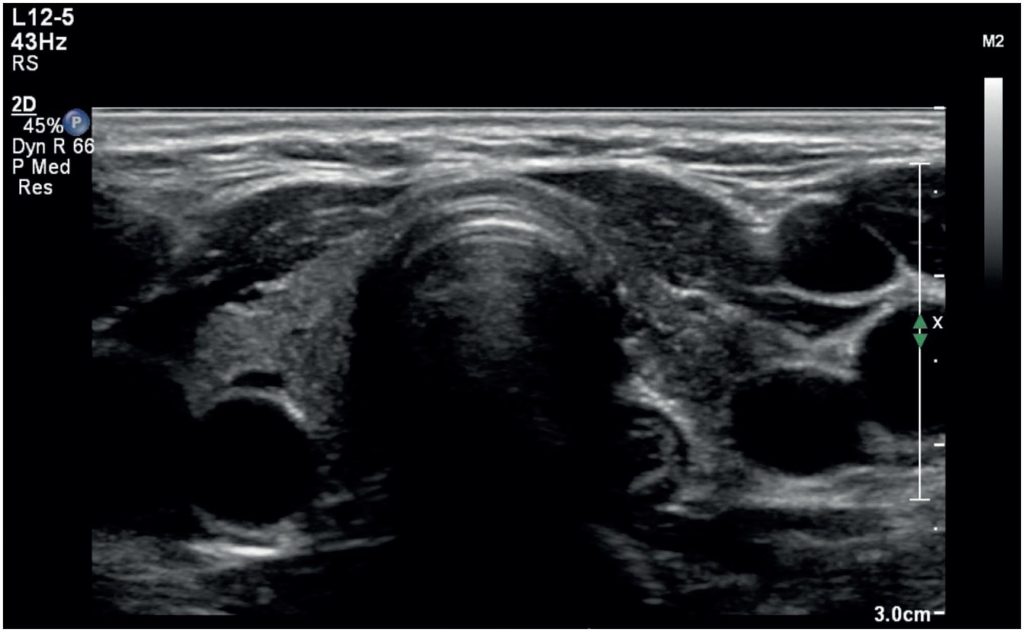 Atrophic hypothyroidism associated with thyrotropin receptor antibodies ...