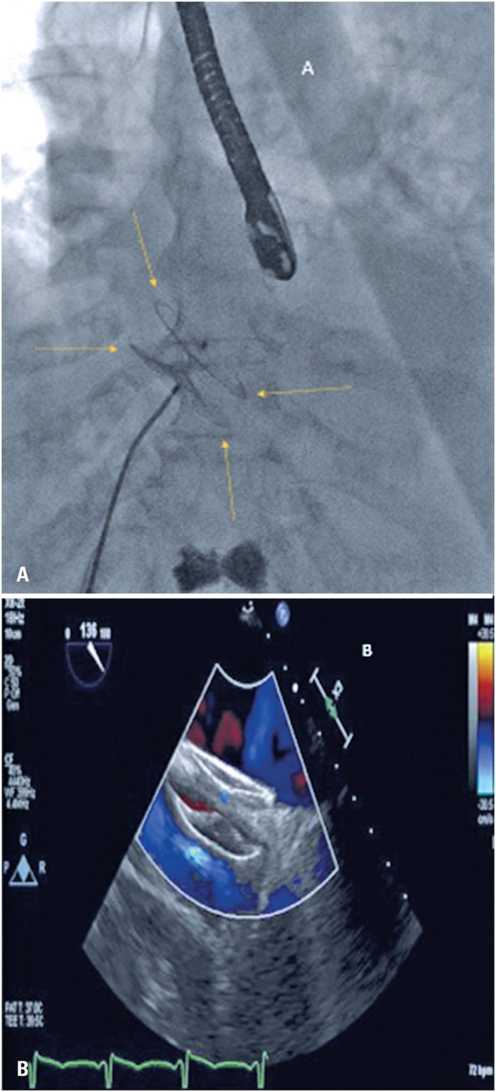 Platypnea-orthodeoxia syndrome: echocardiography-guided percutaneous ...