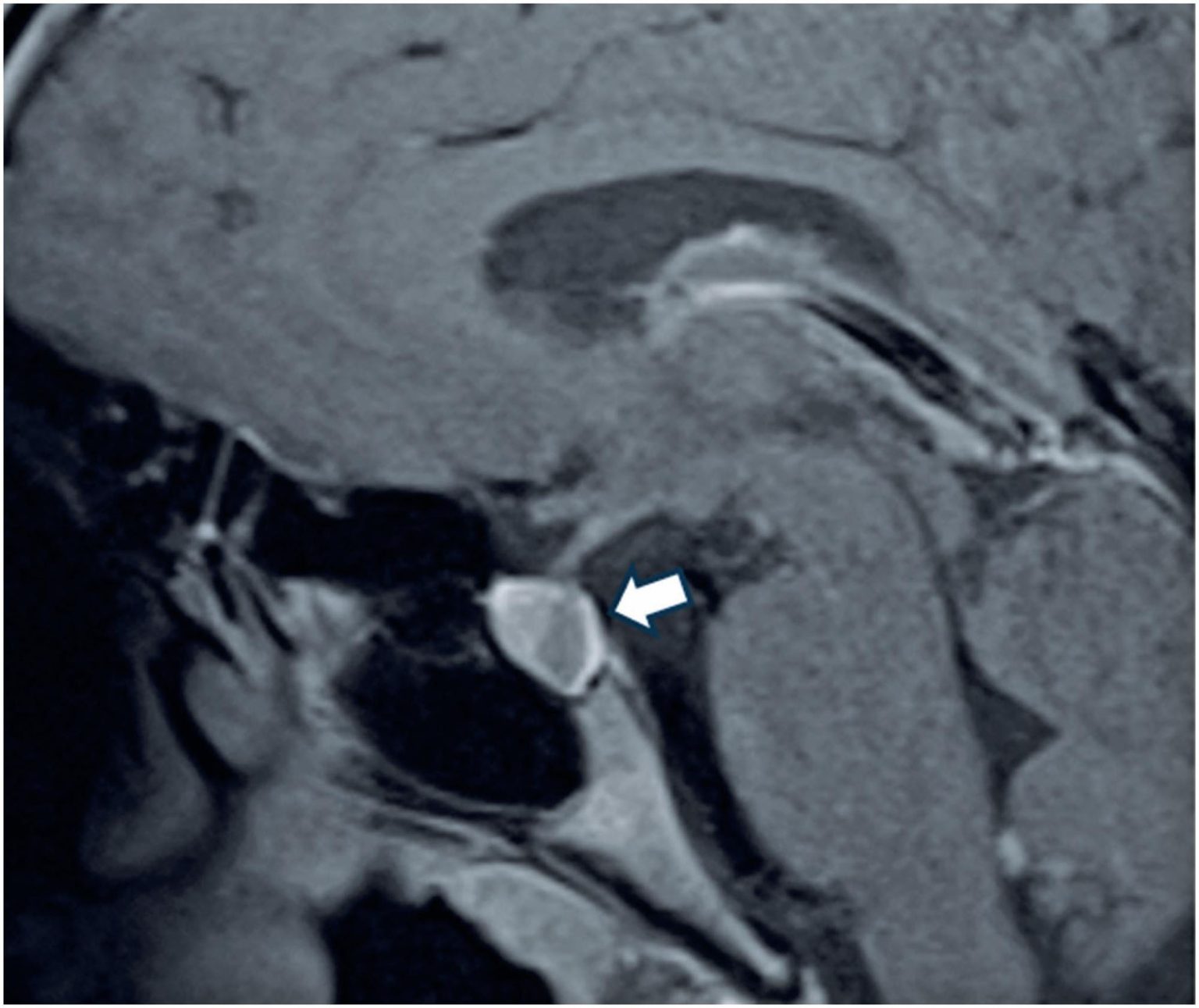 Hypopituitarism and Rathke's cleft cyst in 48,XXYY Syndrome: new ...